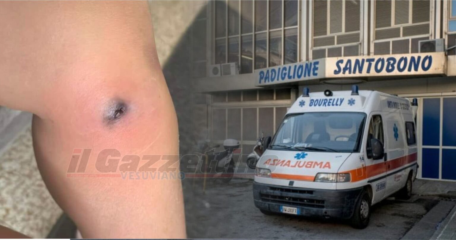 Bimbo morso da ragno violino a Caivano: salva la gamba grazie a un ...